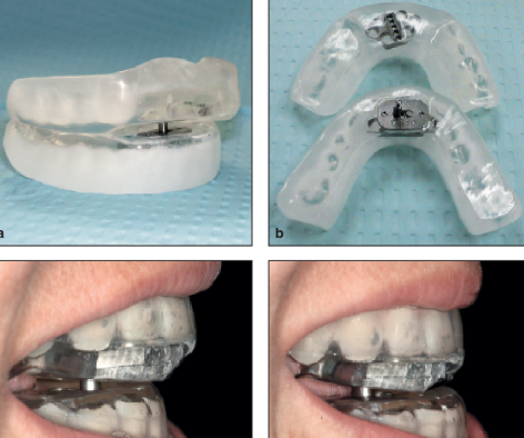 Best Mandibular Advancement Device for Sleep Apnea: Comprehensive Guid ...